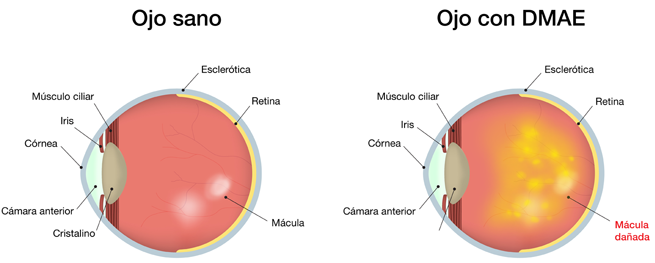 Salud Visual: lo que debes saber sobre la DMAE