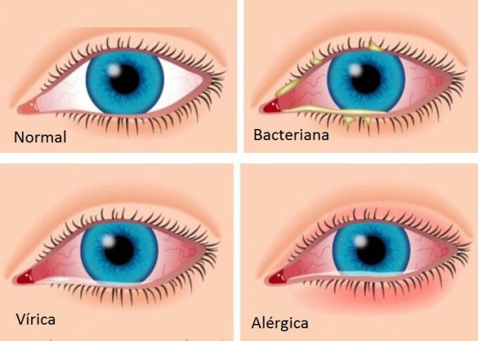 Conjuntivitis Tipos Y Causas
